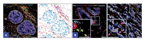 High Resolution Spatial Proteomics Accelerates Personalized Insights