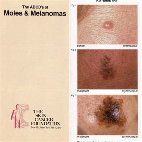 Getting To Know Your Moles First American Publication For Melanoma