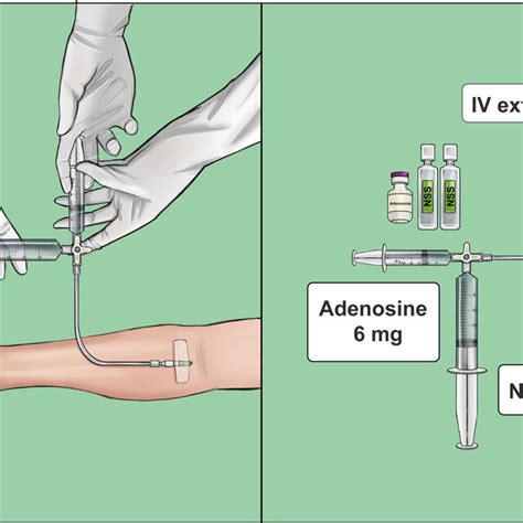 The Double‐syringe Technique Dst For Adenosine Administration Download Scientific Diagram