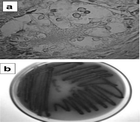 INVASIVE CRYPTOCOCCUS LAURENTII DISEASE IN A NINE YEAR OLD B The Pediatric Infectious