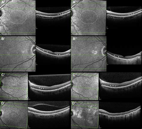 Reticular Pseudodrusen In Late Onset Retinal Degeneration