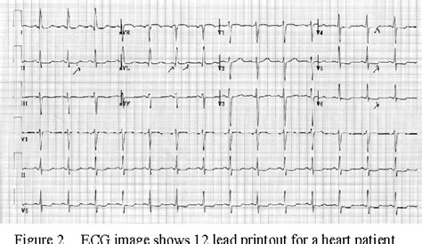 Figure 2 From A Novel Method For Digitizing Standard Ecg Papers Semantic Scholar