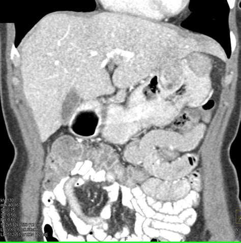 Multiple Gastric Gist Tumors Case Study Stomach Case
