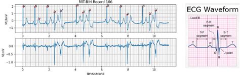 Figure 2 From A Self Contained Stft Cnn For Ecg Classification And Arrhythmia Detection At The