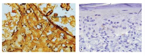 LEC Complement System And Chronic Inflammation Flashcards Quizlet