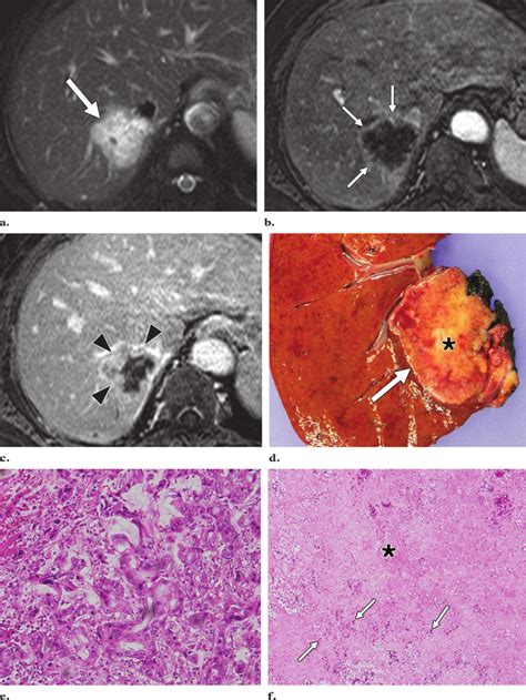 Typical Mr Imaging Features Of Mass Forming Cholangiocarcinoma A