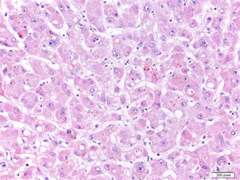 Wilsons Disease Liver