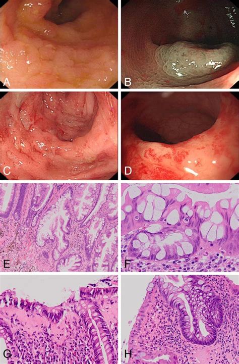 Lower Gastrointestinal Endoscopy Guidance On Indications For Biopsy Pmc