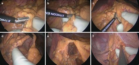 Total Colectomy And Proctocolectomy Hand Assisted Laparoscopic Approach Abdominal Key