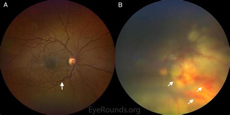 Endogenous Endophthalmitis