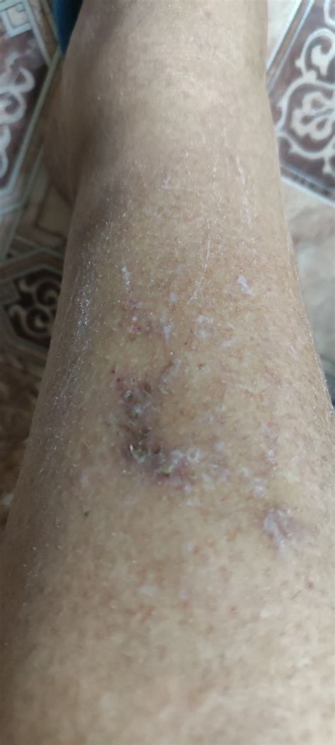 Красные пятна на ногах Приблизительно 2 месяца назад появилось на ноге Medaboutme