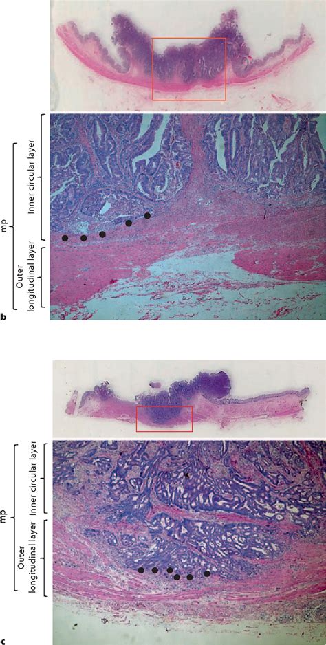Figure 2 From Analysis Of Lymph Node Metastatic Pattern According To The Depth Of In Growth In