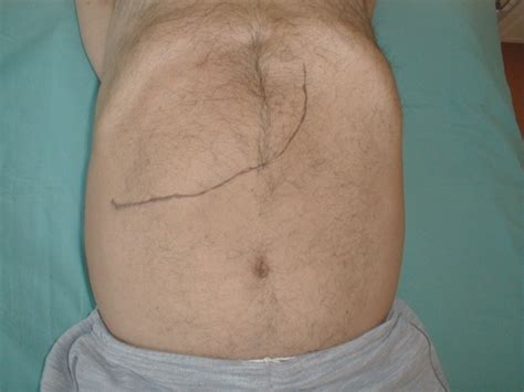 Enlarged Xiphoid Process