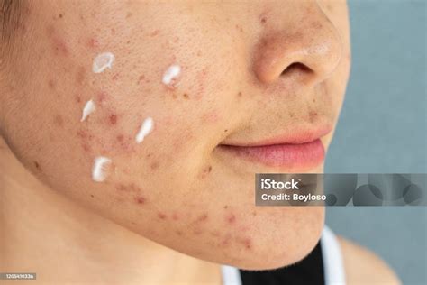 그녀의 얼굴에 여드름 염증 와 여자 반 얼굴의 자른 샷과 그녀는 치료를 위해 그녀의 얼굴에 여드름 크림을 적용 보습제에 대한 스톡 사진 및 기타 이미지 Istock