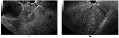 Endoscopic Ultrasound Benefits At Andrew Godina Blog