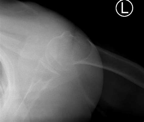 Proximal Humerus Fractures Trauma Orthobullets