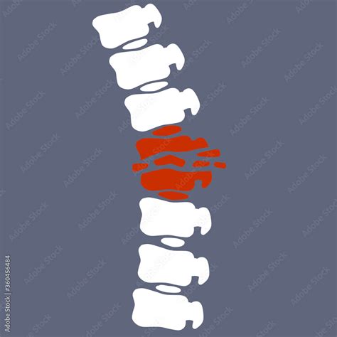 Problems With Spine Posture Issues Vertebral Column Crack In The White Bone Cartoon Flat