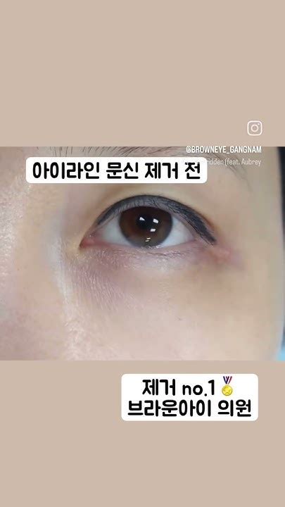 아이라인 제거 한 번으로 너무 예쁜 청초한 눈을 되찾았어요😊🩷 Youtube