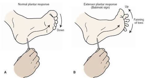 Kenhub The Babinski Test The Plantar Reflex Is A