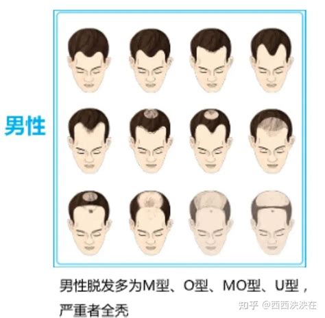 你到底是脱发or掉发？ 知乎