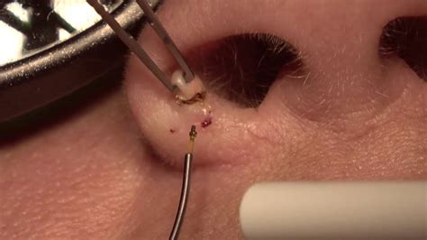 Polyp In The Nose Rpimplepopperdelight