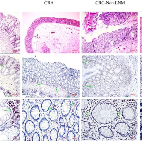 Expression Of Tams In Intestinal Tissues With Or Without Lymph Node