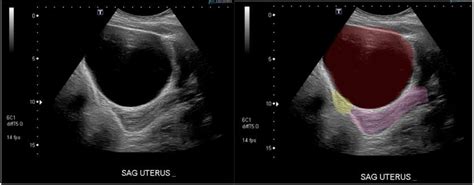 Female Abnormal Bladder Ultrasound