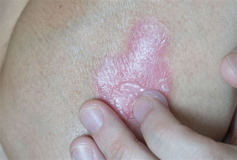 Why Does Psoriasis Itch How To Get Relief