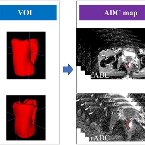Process Of The Tumor Segmentation And Feature Extraction The Volume Of Download Scientific