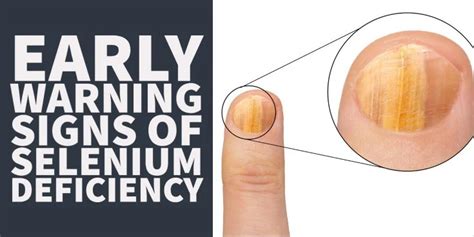 8 Early Symptoms Of Selenium Deficiency And Your Next Steps