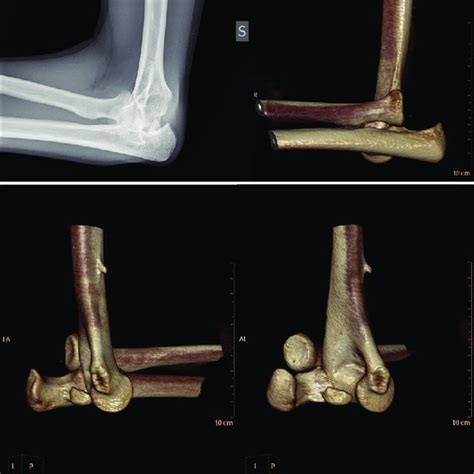 X Ray And 3d Ct With Fracture Dislocation Of The Left Elbow Download Scientific Diagram