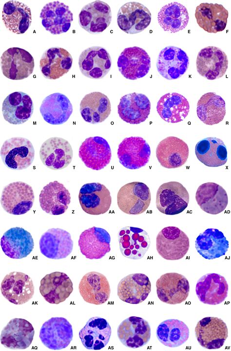 Band Vs Segmented Neutrophils