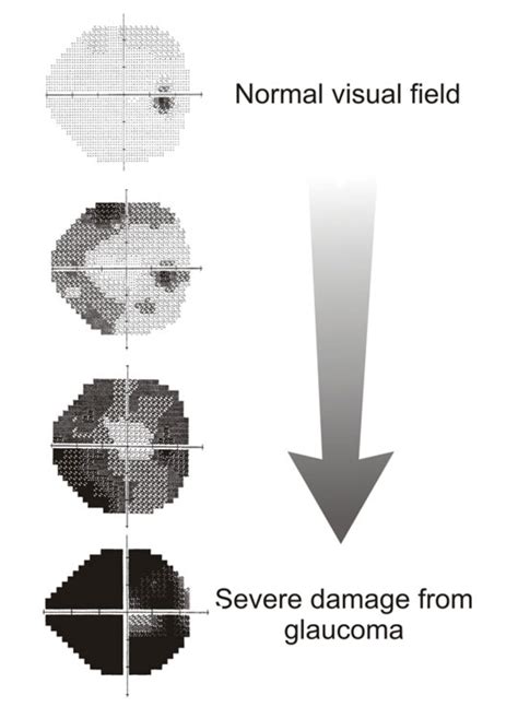 What Is Glaucoma — Wollongong Eye Doctor Ophthalmologist Dr Steven