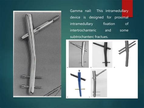 Intramedullary Nailing PPTX First Aid Injuries