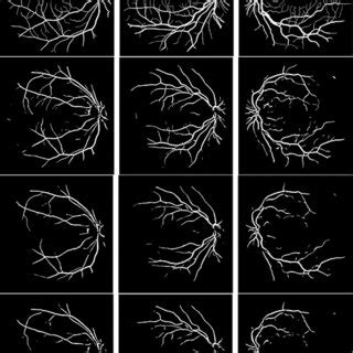 Segmentation Results Of Vessels On Fundus Images First Row Sample Download Scientific Diagram