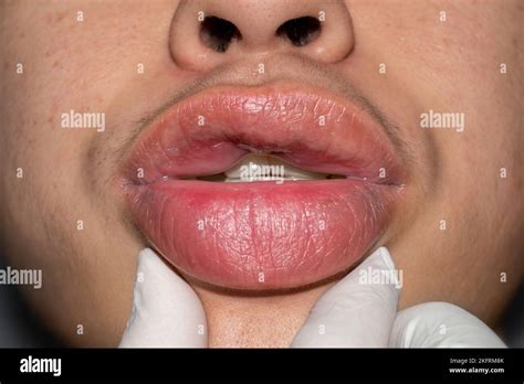 Canker Sore Lip Swollen