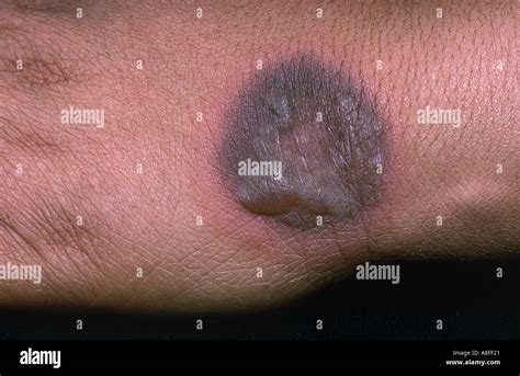 Eritema Multiforme Immagini E Fotografie Stock Ad Alta Risoluzione Alamy