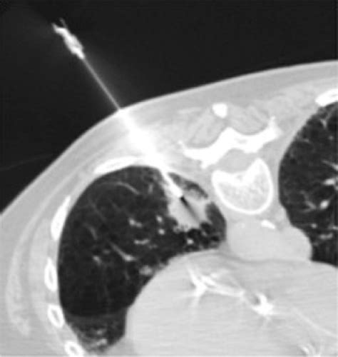 What Is A Ct Guided Biopsy Of The Lung At Thomas Ogle Blog