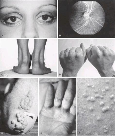 Sara Annonu On Linkedin Physical Findings Of Hyperlipidemia A Xanthelasma B Lipemia…