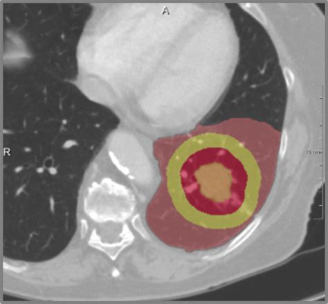 Safety Margin Between Tumor And Segment Border Download Scientific