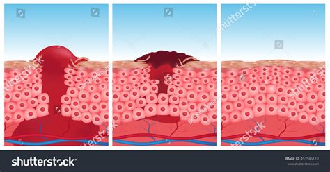 528 Scabs Stock Illustrations Images And Vectors Shutterstock