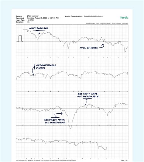 Unreadable Noisy Vs Atrial Fibrillation On Your Watch Ecg Qaly