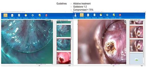 Using High Resolution Anoscopy To Detect Anal Dysplasia Due To