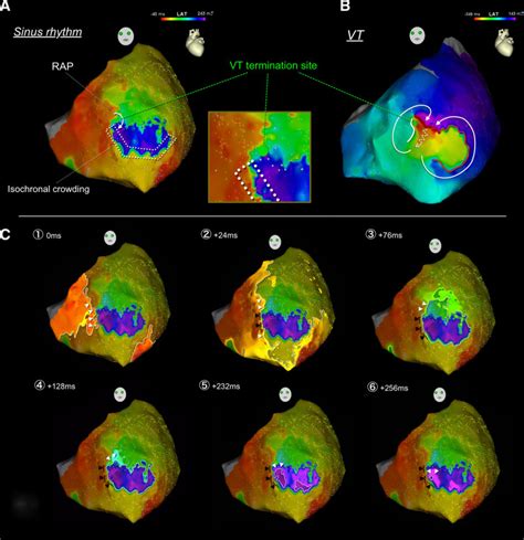 Rotational Activation Pattern During Functional Substrate Mapping Novel Target For Catheter