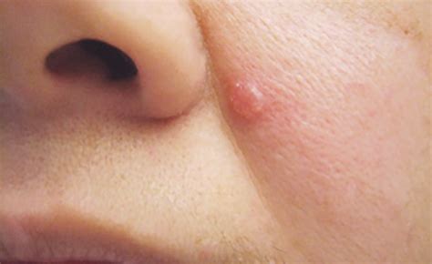 Squamous Cell Carcinoma Risks And Dangers Of This Skin Cancer