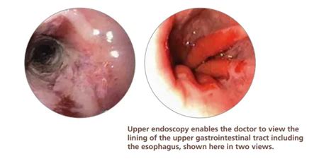 Upper Endoscopy Egd Gastroenterologist In Forest Hills Ny Forest Hills Gastroenterology