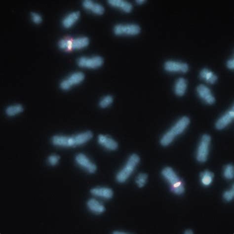 Ivd Fip1l1chic2 Pdgfra Triple Color Ish Probes Molecular Pathology