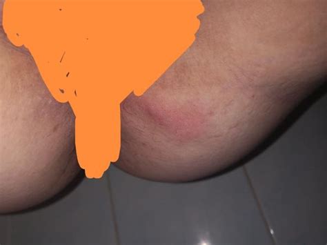 Je To Absces Modrý Koník