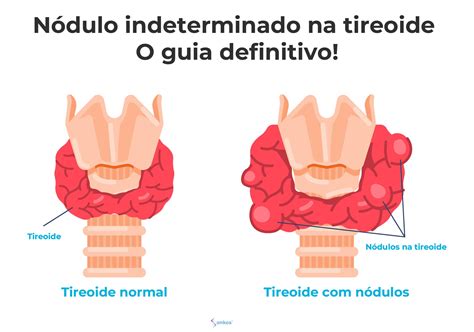 Nódulo De Tireoide Benigno E Maligno Quais As Diferenças Onkos