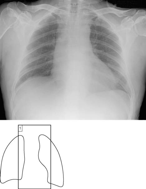 Aortic Dissection X Ray